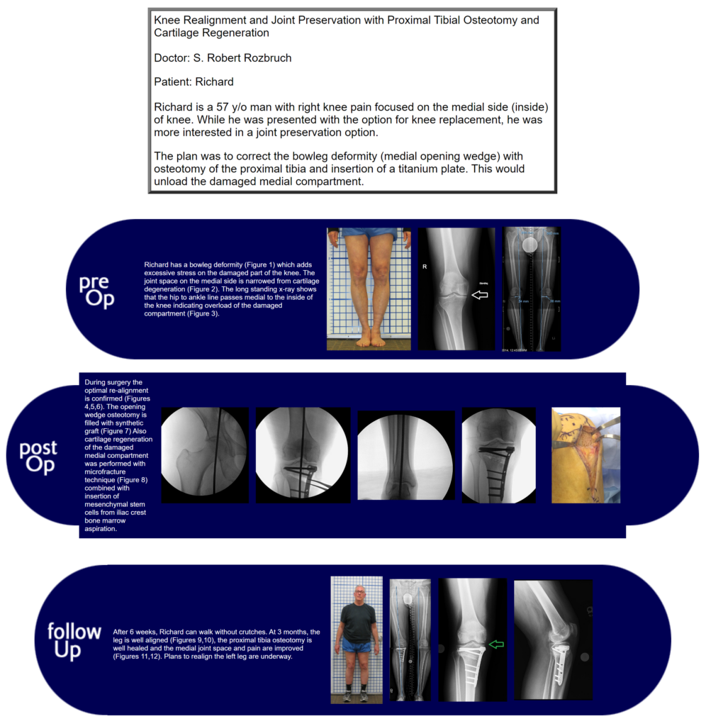Knee Realignment And Joint Preservation With Proximal Tibial Osteotomy And Cartilage