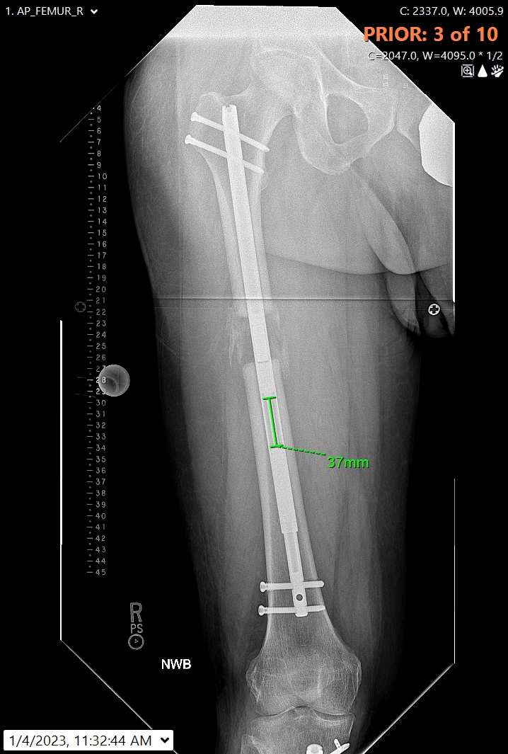Limb Lengthening Overview - Limb Lengthening