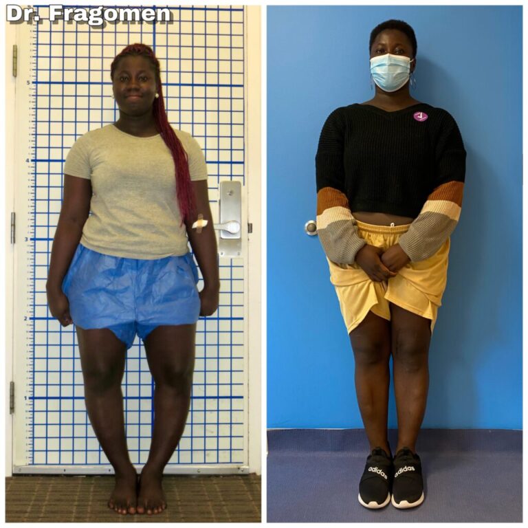 Before and After Images - Limb Lengthening