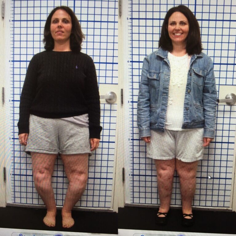 Bowleg Before and After Photos – Limb Lengthening