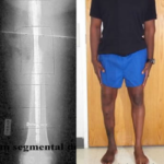 Femur Non-Union and Bone Defect Before and After Photos - Limb Lengthening