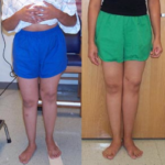 Hip Reconstruction Before and After Photos – Limb Lengthening