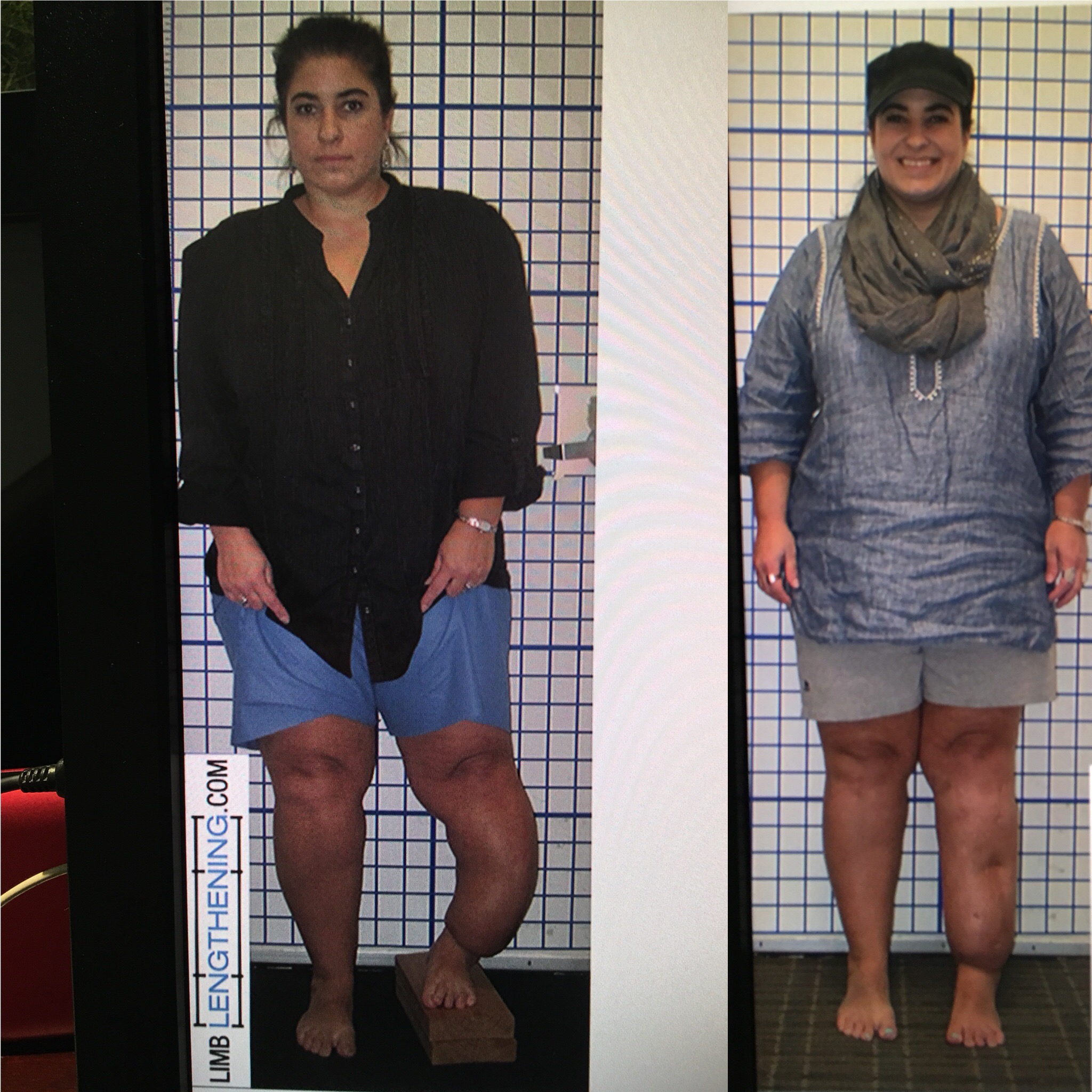 Bowleg Before and After Photos – Limb Lengthening