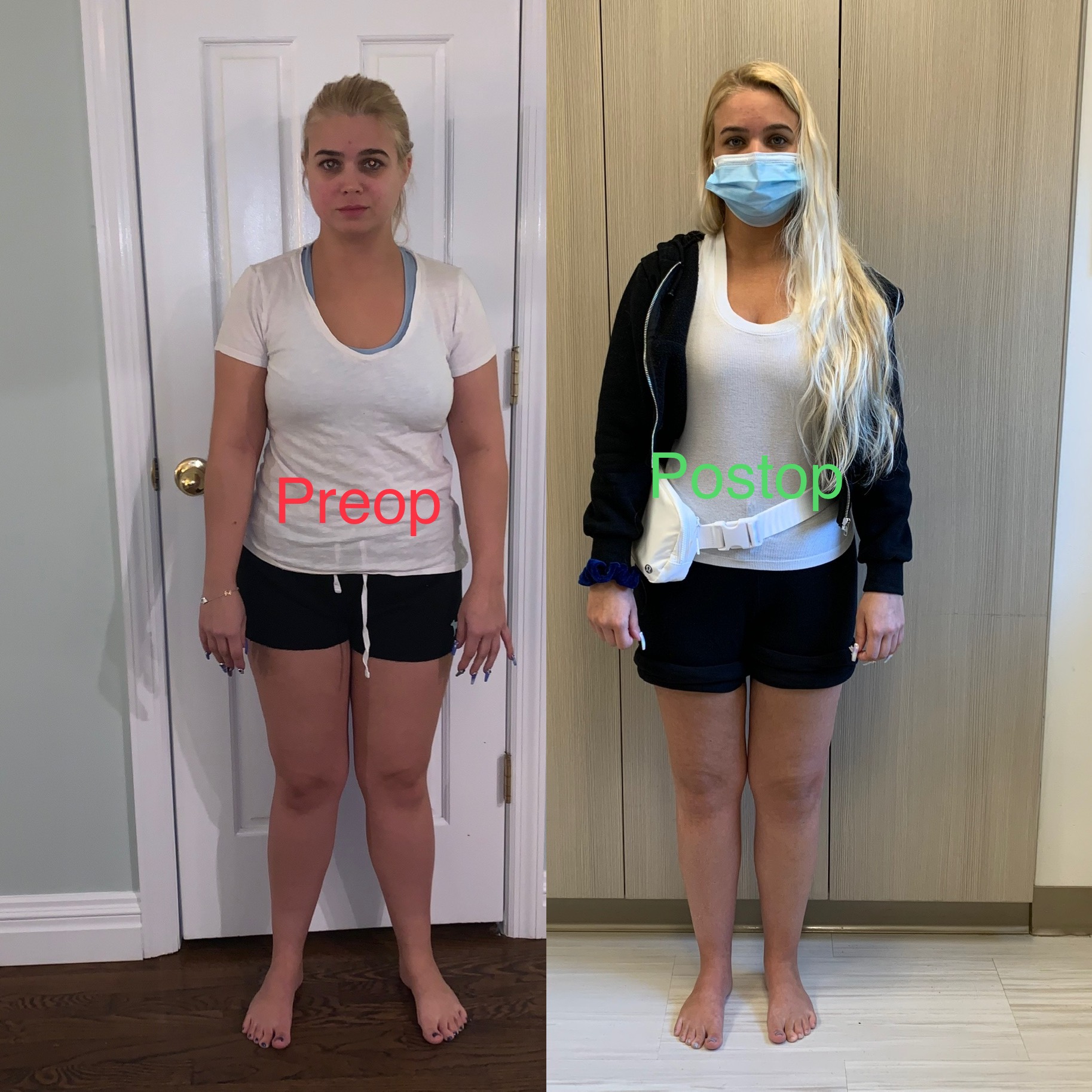 Knock Knee Deformity Before and After Photos – Limb Lengthening