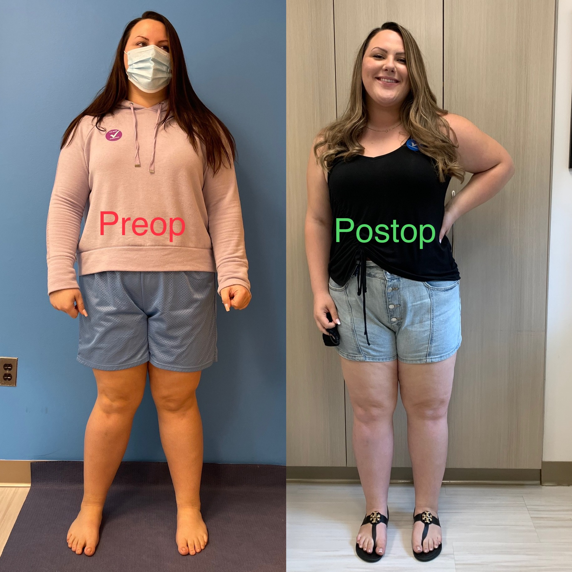 Knock Knee Deformity Before and After Photos – Limb Lengthening