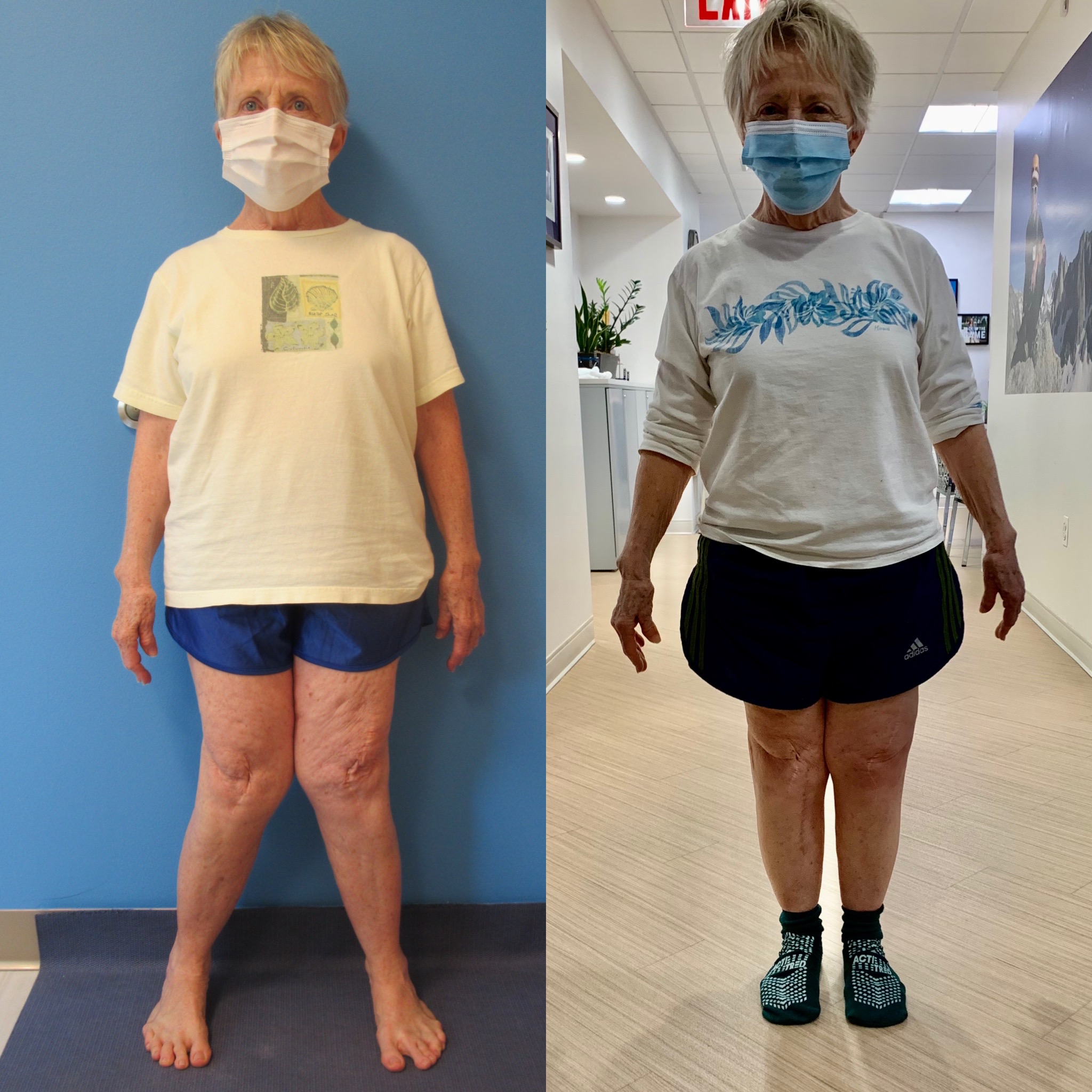 Knock Knee Deformity Before and After Photos – Limb Lengthening