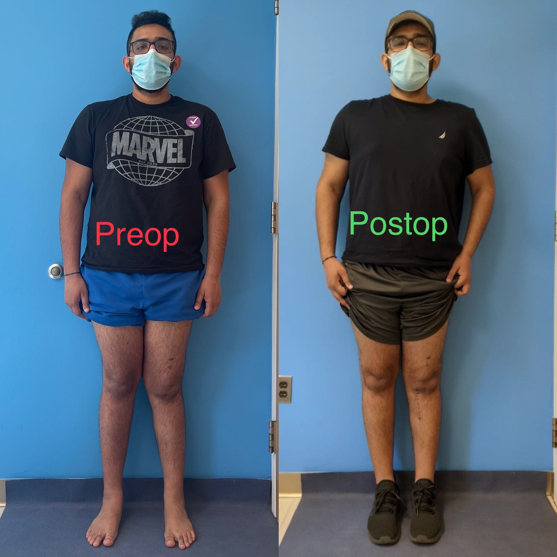 Knock Knee Deformity Before and After Photos – Limb Lengthening