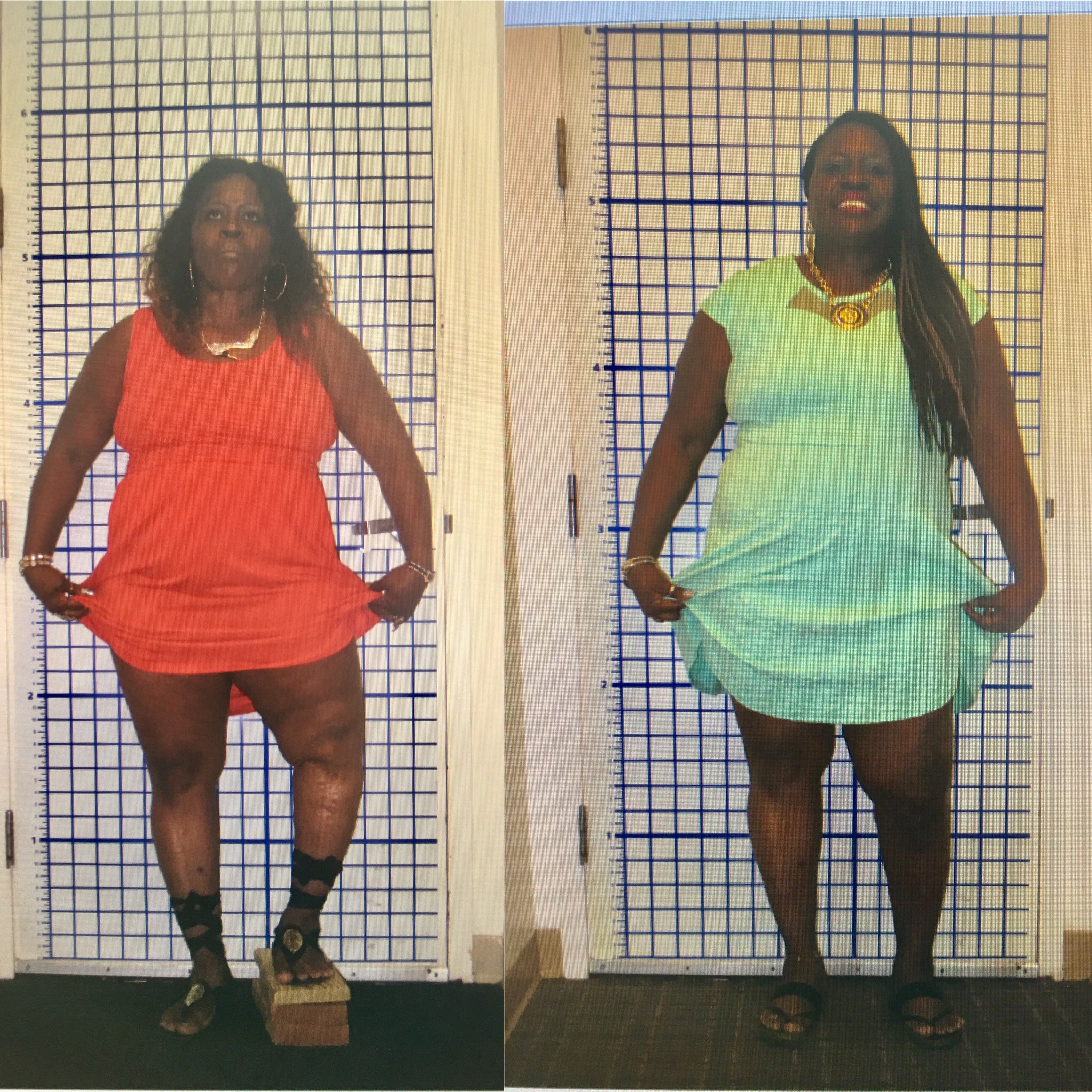 Bowleg Before and After Photos – Limb Lengthening