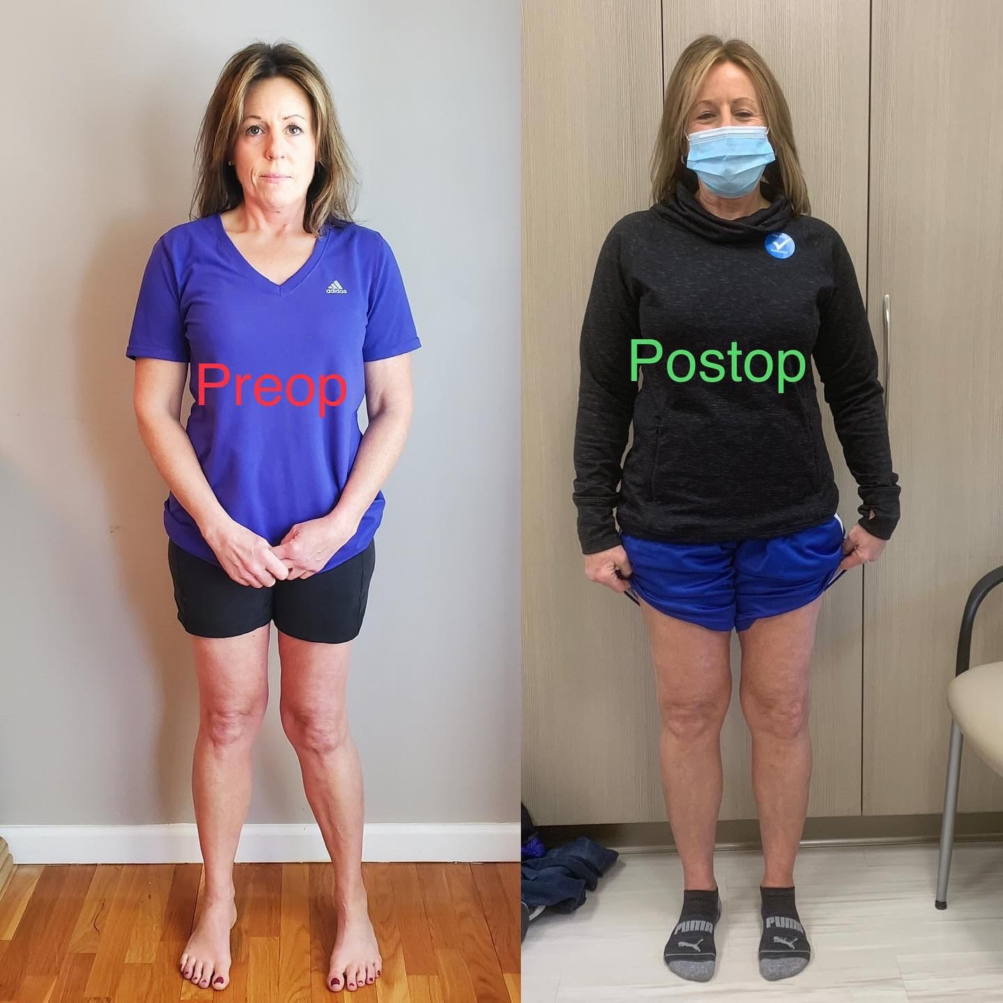 Knock Knee Deformity Before and After Photos – Limb Lengthening