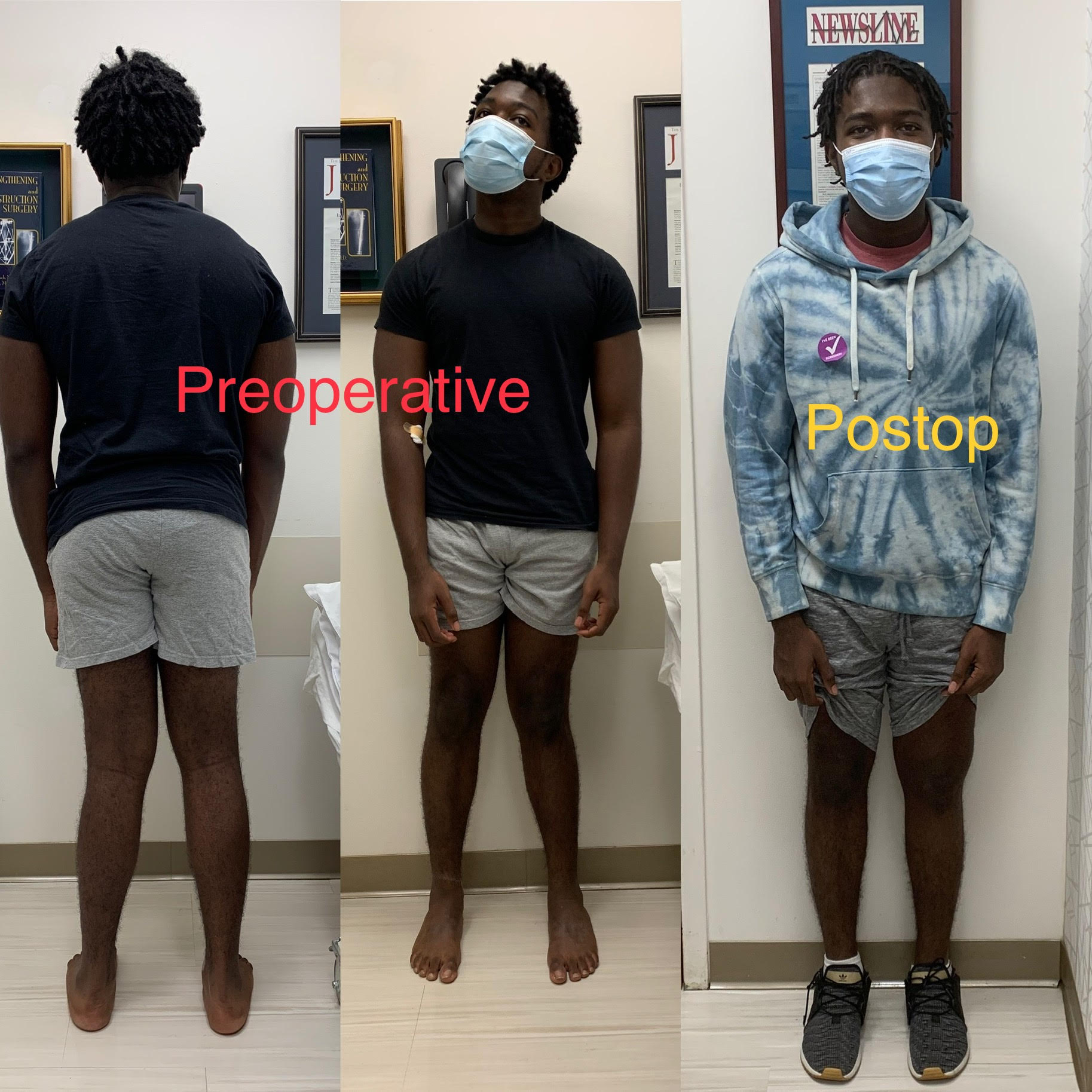 Knock Knee Deformity Before and After Photos – Limb Lengthening