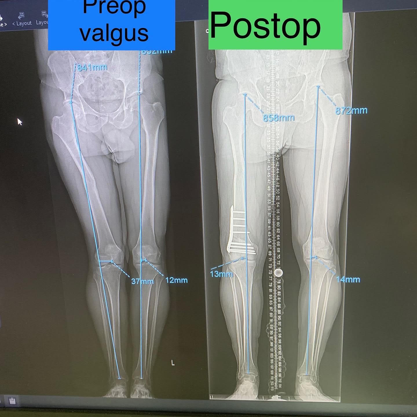 Knock Knee Deformity Before and After Photos – Limb Lengthening