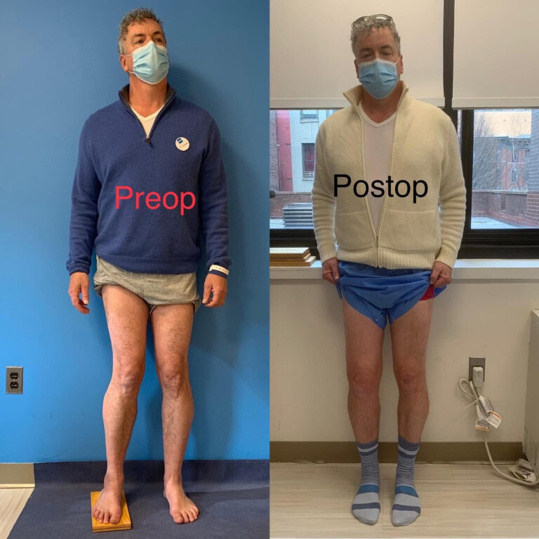 Knock Knee Deformity Before and After Photos – Limb Lengthening
