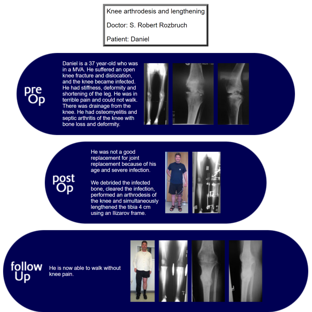 Knee Arthrodesis And Lengthening Limb Lengthening
