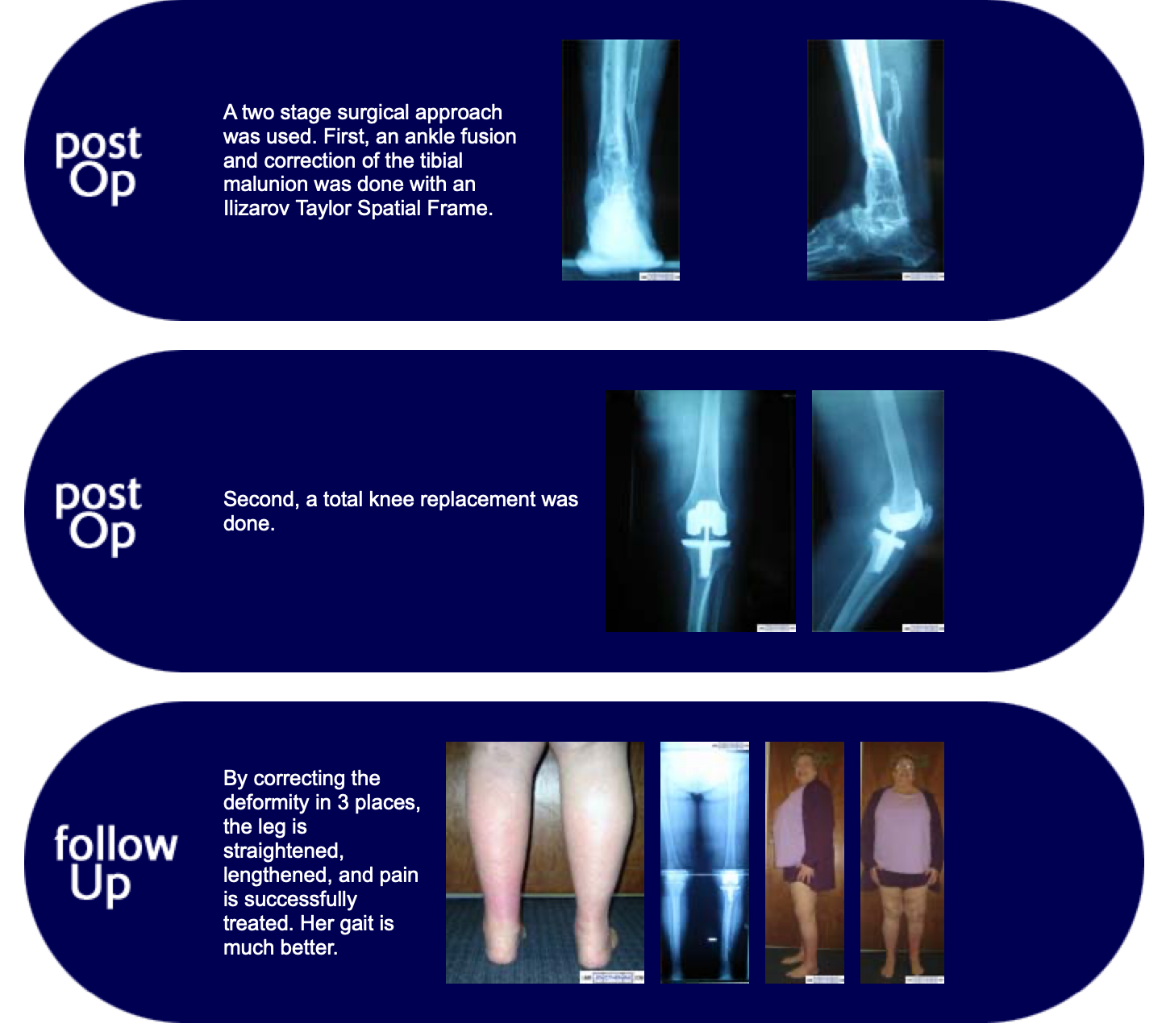 Madeleine - Knock Knee Correction - Limb Lengthening