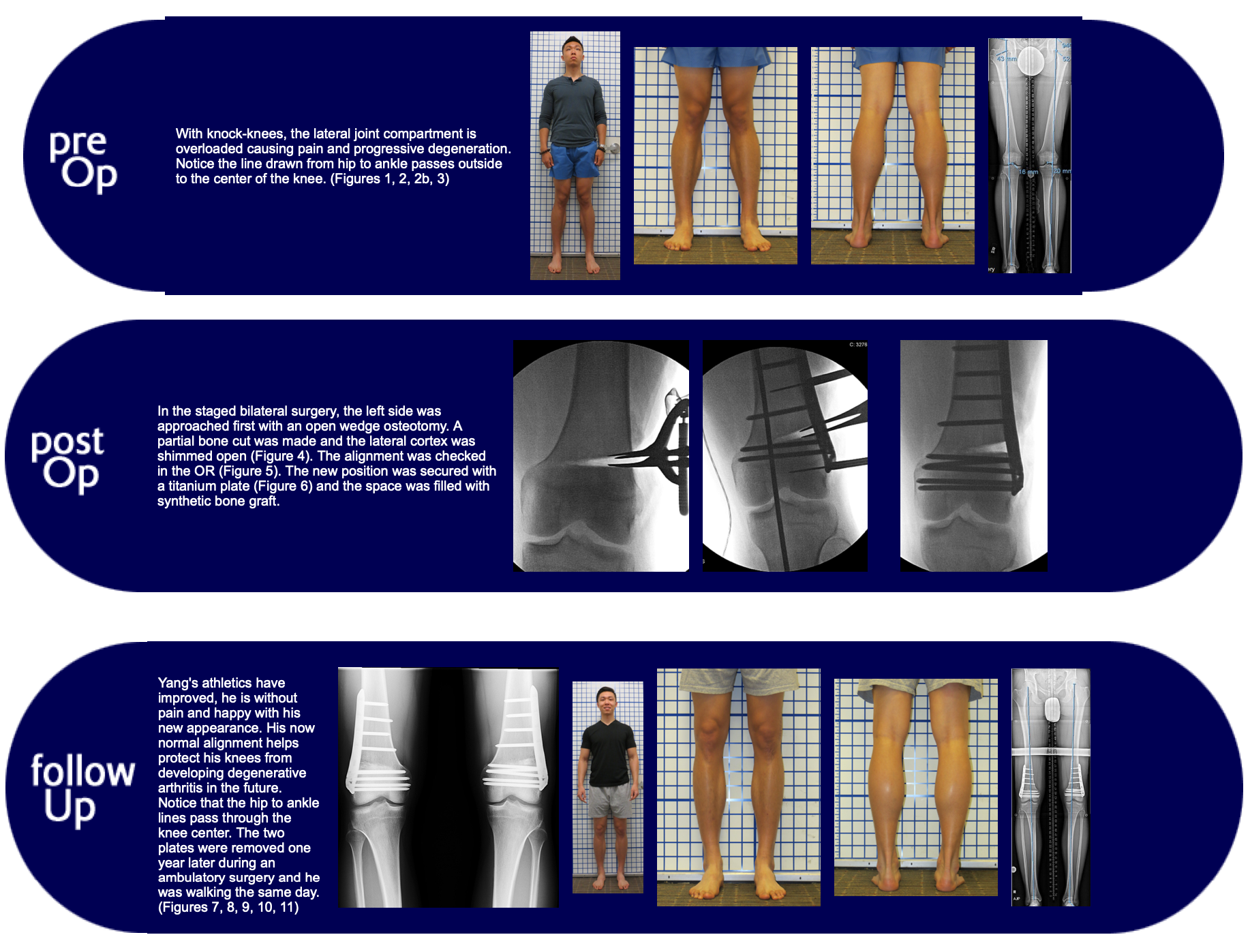 Correction of Bilateral Knee Valgus (Knock-knee) with Osteotomy and ...