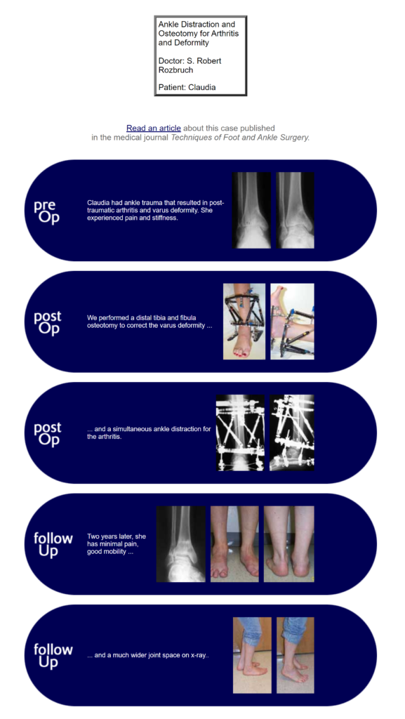 Case History #35 Ankle Reconstruction through Distraction of the Ankle ...