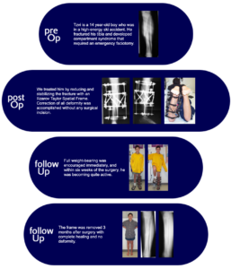 Complex Tibia Fracture in Child - Limb Lengthening