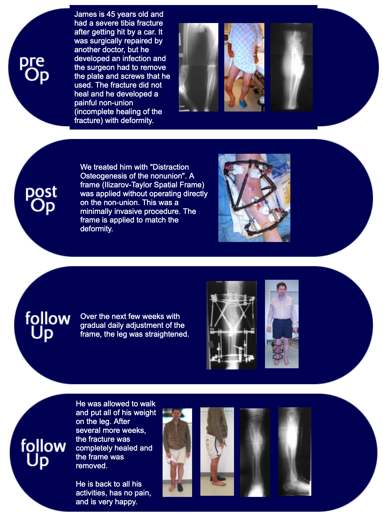 Distraction of Tibial Non-Union – Limb Lengthening
