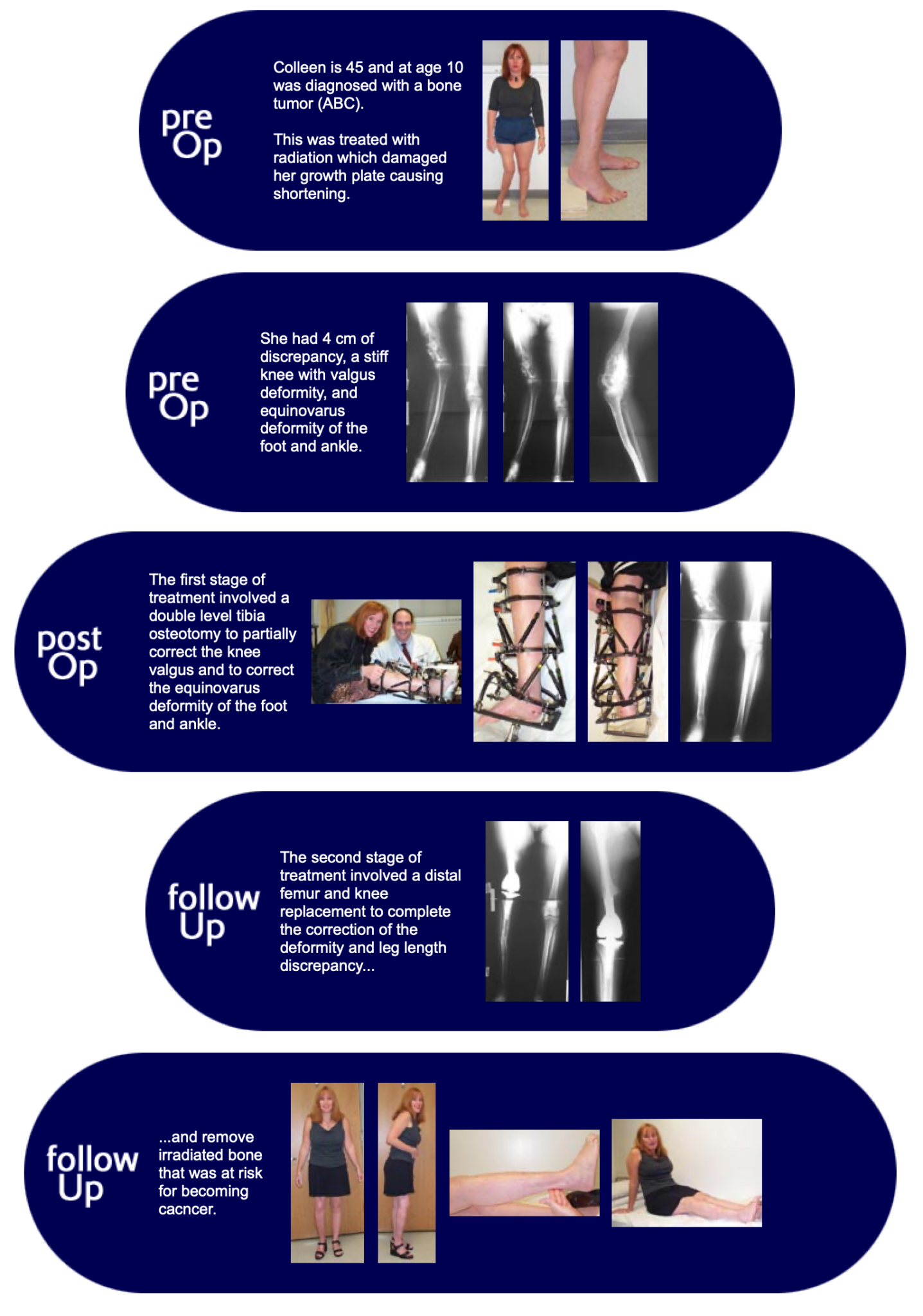 Double Level Tibial Osteotomy and Joint Replacement - Limb Lengthening