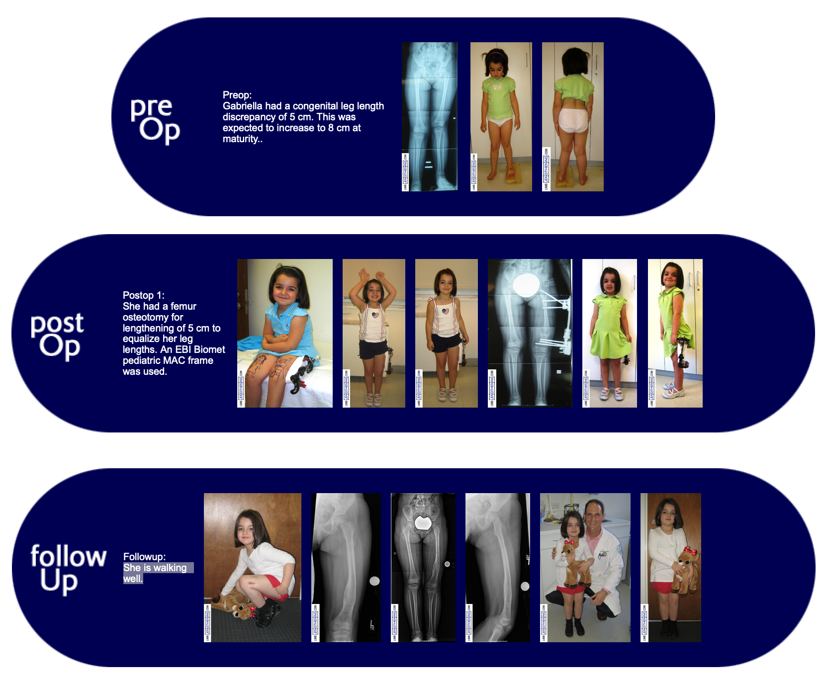 Femur Lengthening in Young Child – Limb Lengthening