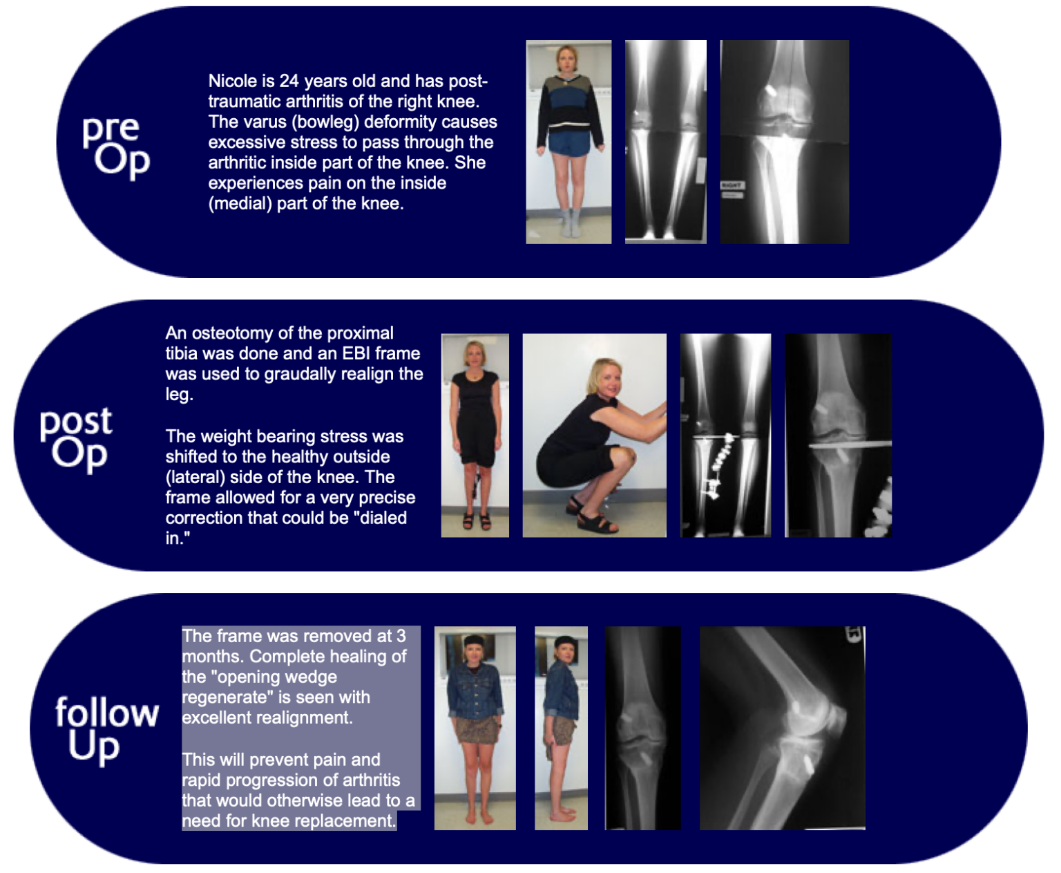 High tibial osteotomy for knee realignment – Limb Lengthening