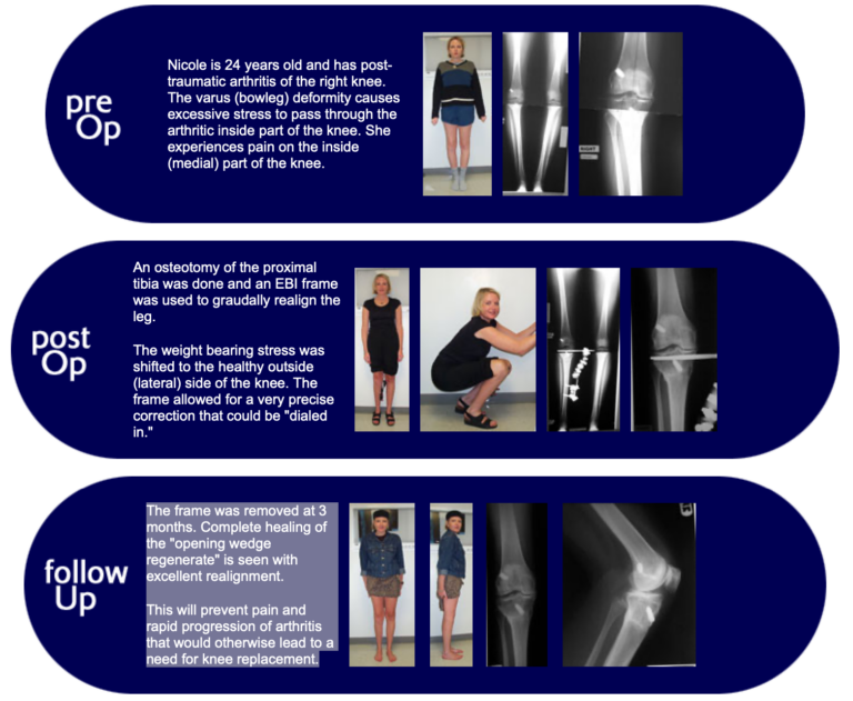 High tibial osteotomy for knee realignment – Limb Lengthening