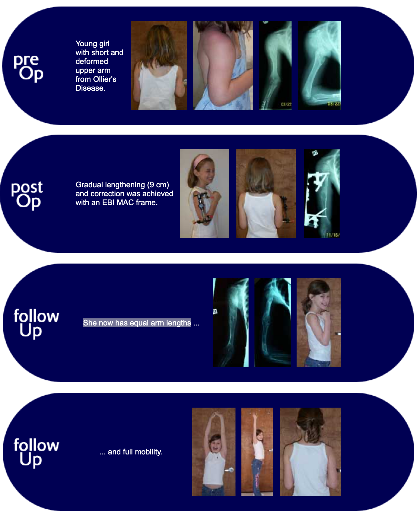 Lengthening and Straightening of Humerus in a Child - Limb Lengthening