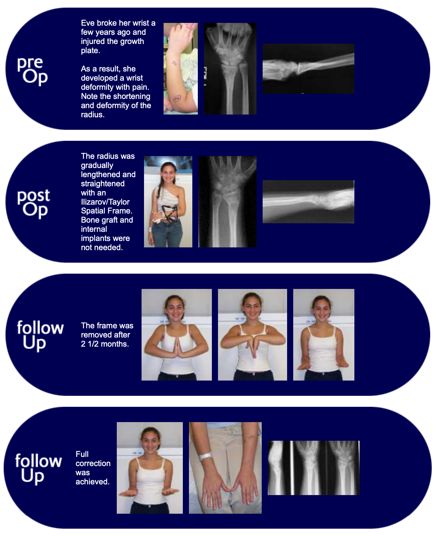 Radius Lengthening in Child - Limb Lengthening