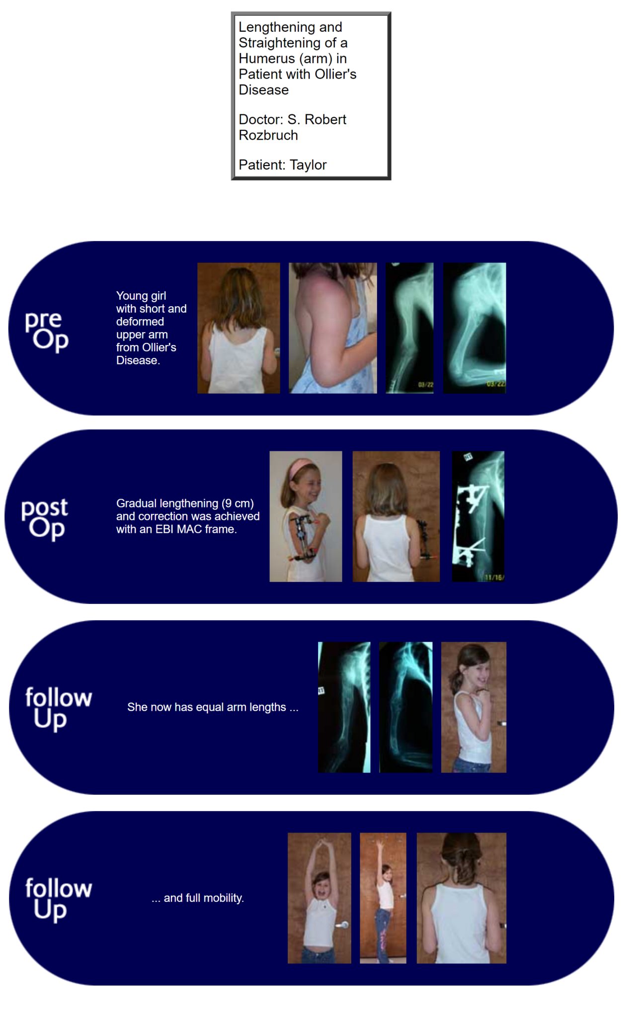 Case History #42 Lengthening and Straightening of a Humerus (Arm) in ...