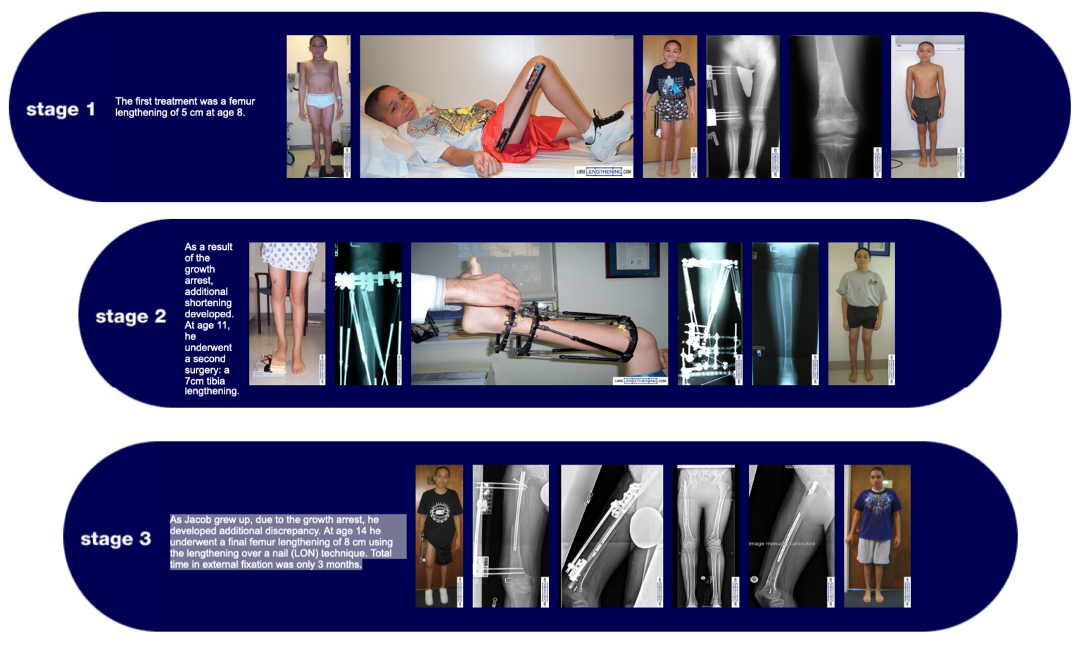 Femur Lengthening Over a Nail - Limb Lengthening