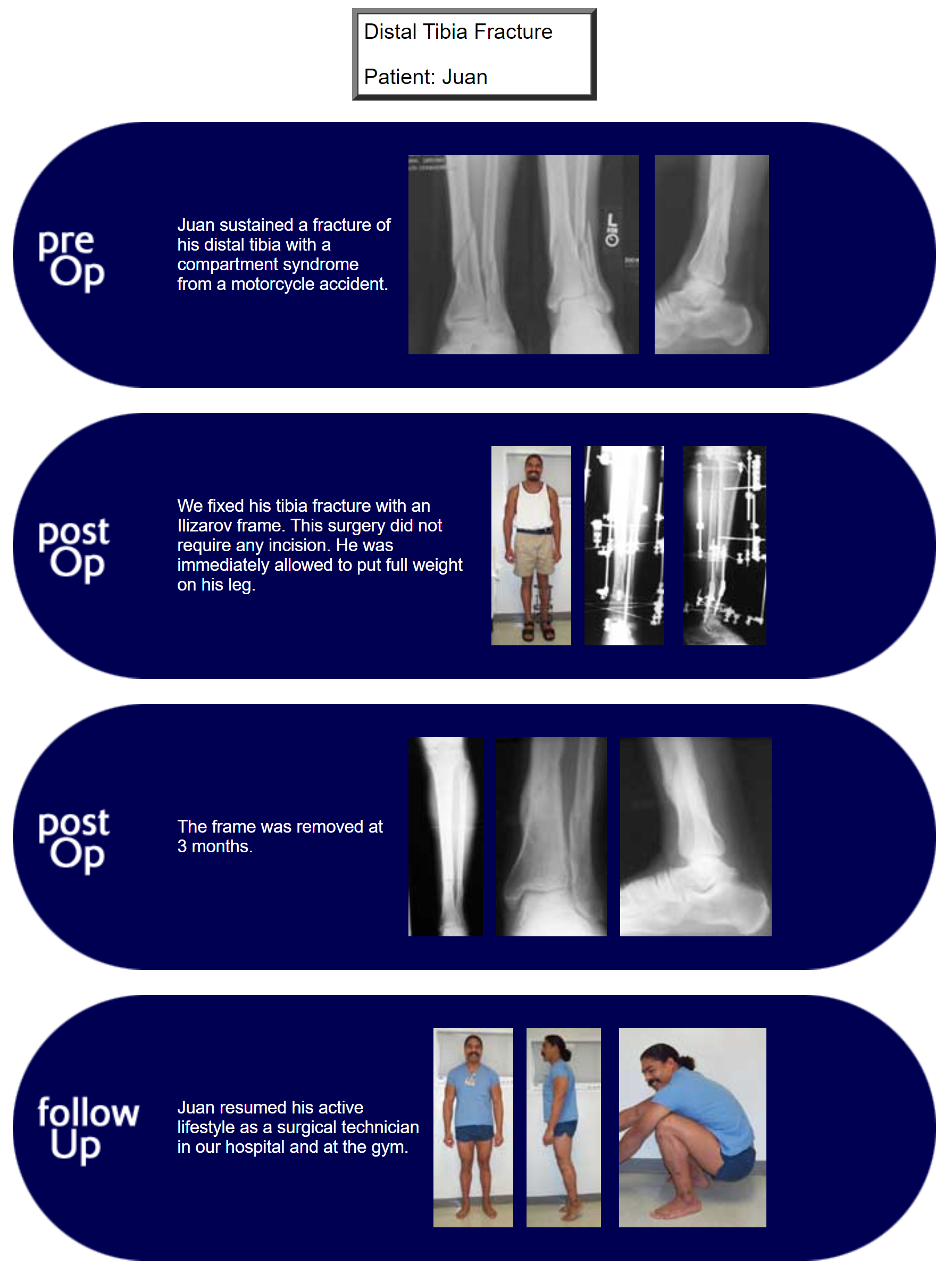 Case History #21 Distal Tibia Fracture – Limb Lengthening