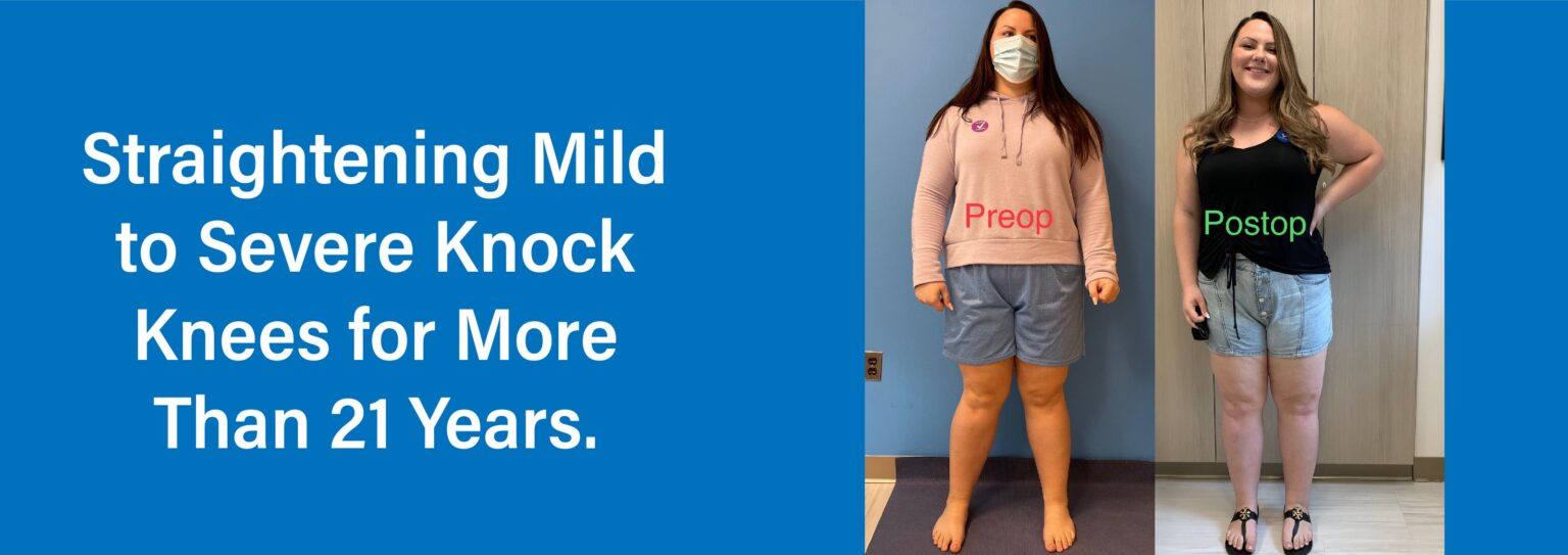 Knock Knee Condition Overview - Limb Lengthening