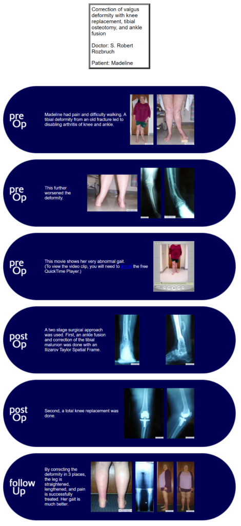 Case History #53 Correction of Valgus Deformity with Knee Replacement ...