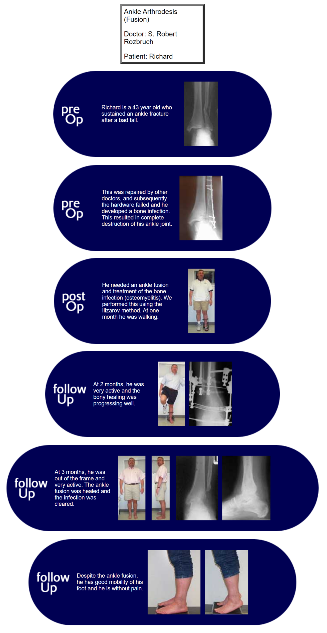 Case History #14 Ankle Reconstruction through Arthrodesis (Fusion ...