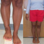 Tibial Lengthening and Deformity Correction Before and After – Limb ...