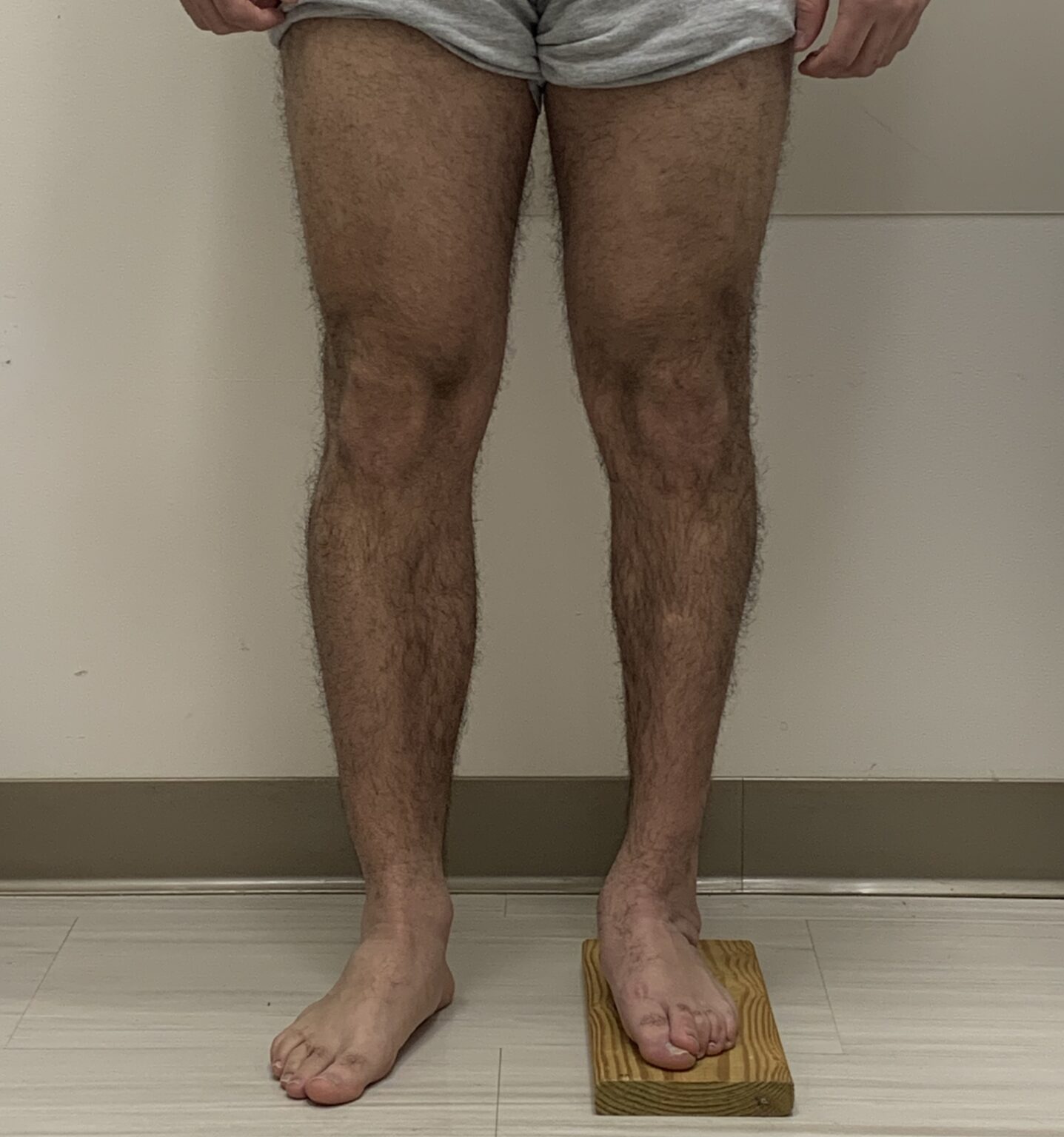 Limb Lengthening Overview – Limb Lengthening