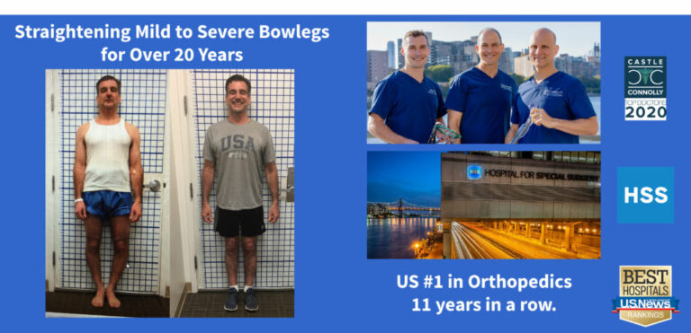 Bowleg Overview - Limb Lengthening